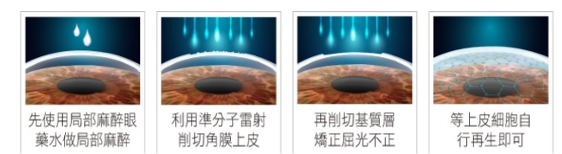 何謂Trans PRK 手術 – e-doctoreye